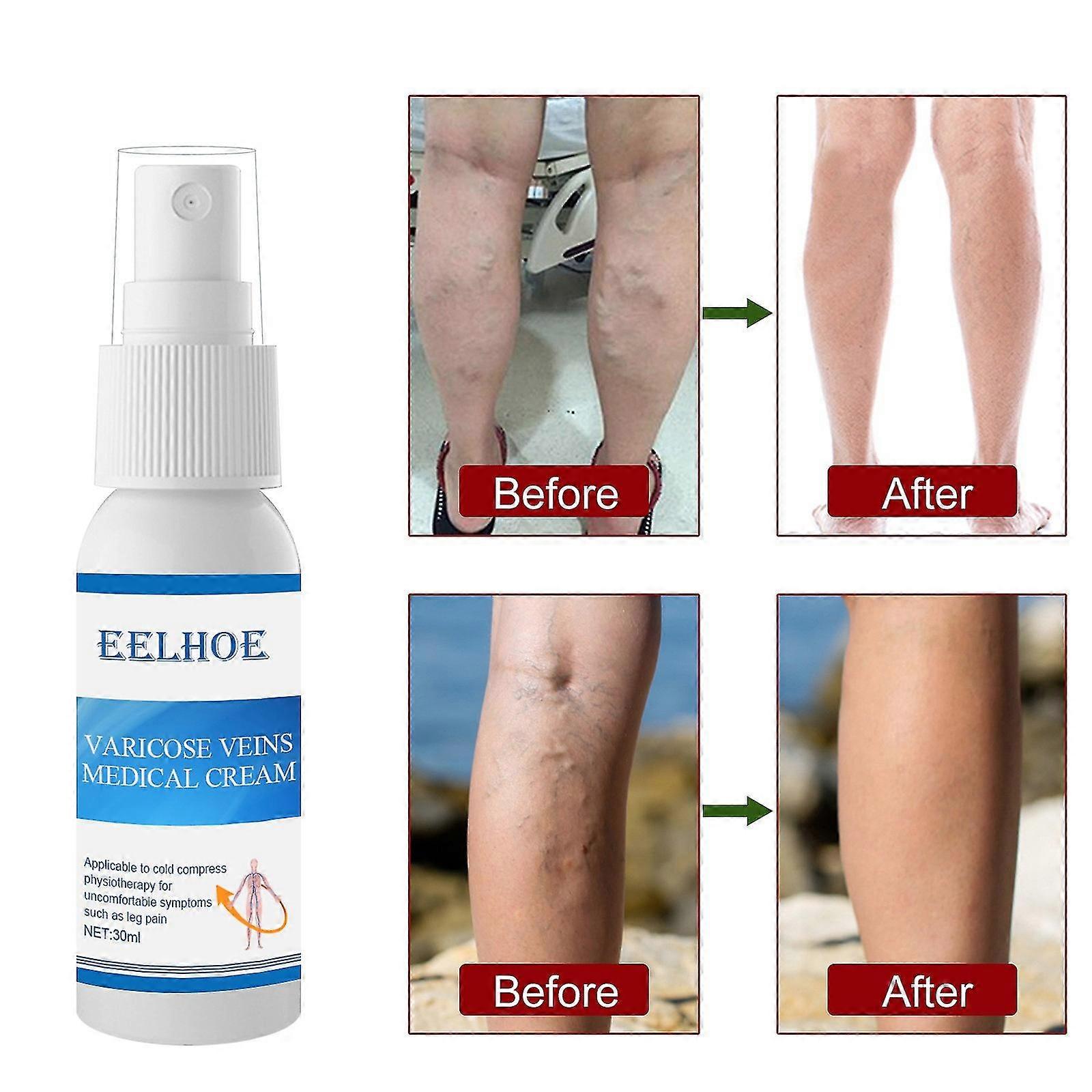 Varicose Veins Spray, Varicose Vein Massage Cream, For Leg Cramps Foot ...