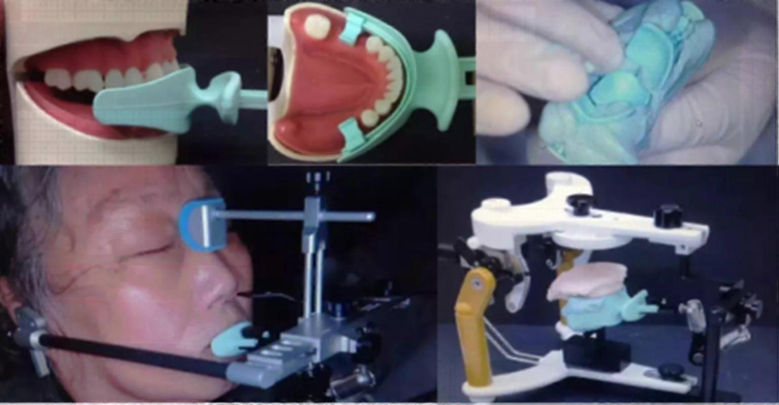 1~50Sets Dental BPS Centric Tray Impression Trays Occlusal Position ...