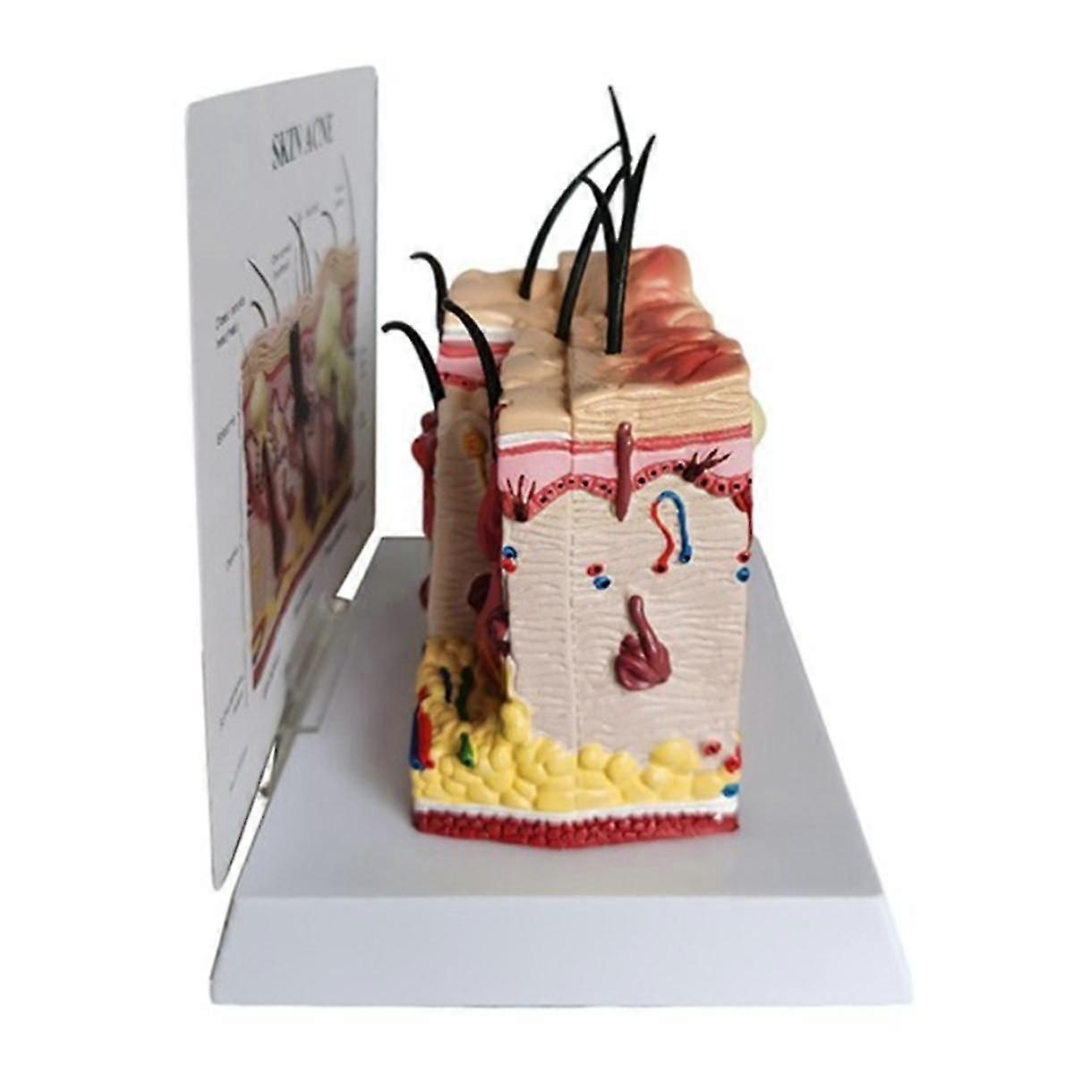 Skin Acne Model, Human Anatomy Normal Common Acne Skin, Physiology ...