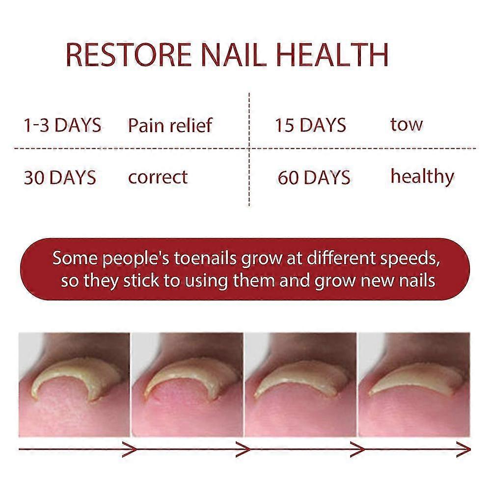 3x Nail Helper Ingrowth Toenail Correction Treatment Oil, Paronychia ...
