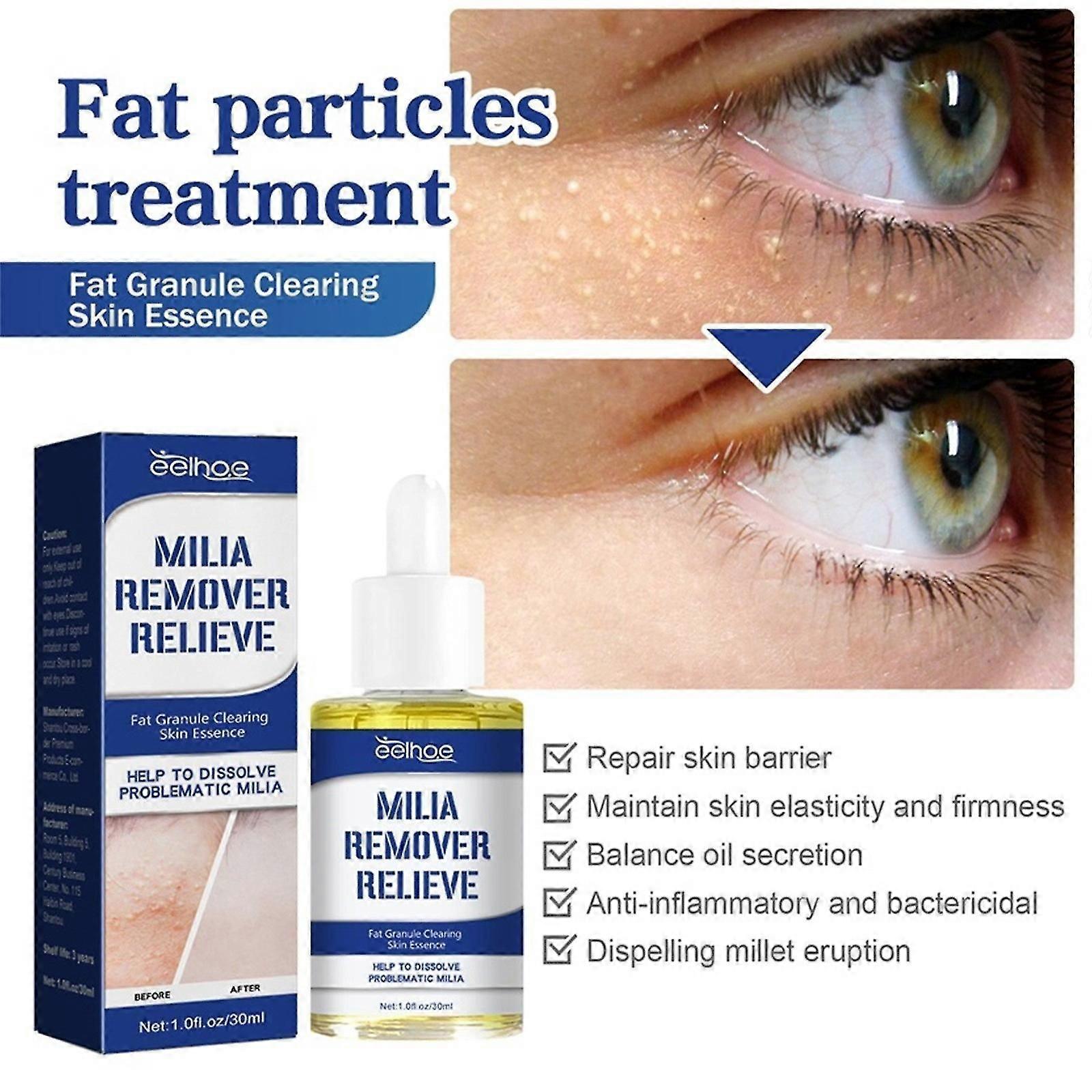 Milia Remover, Milia For Eye, Milia, Sebaceous Hyperplasia 30ml | Fruugo UK