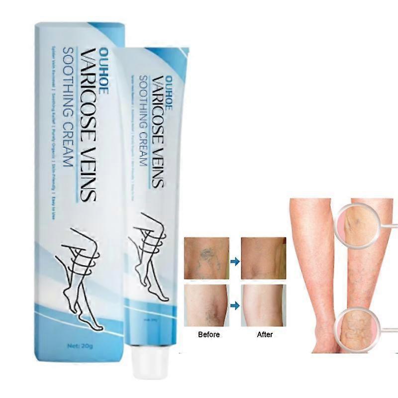 Vein Repair Cream - Improve Blood Circulation and Reduce Varicose Veins ...