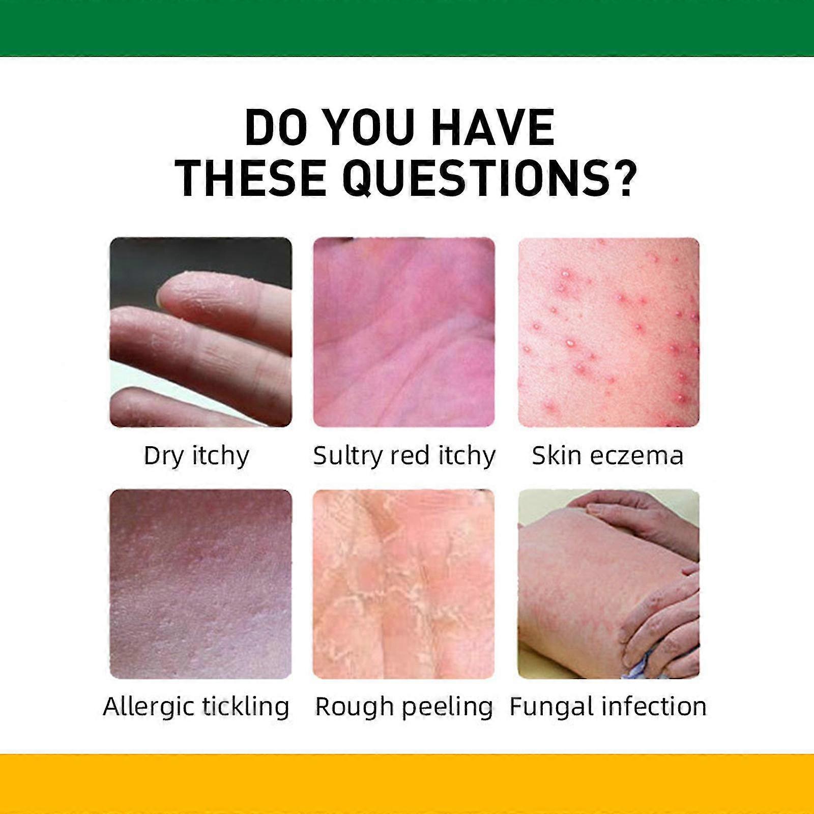 Anti-Itch Cream with Temporarily Relief from Rashes with Eczema-Prone ...