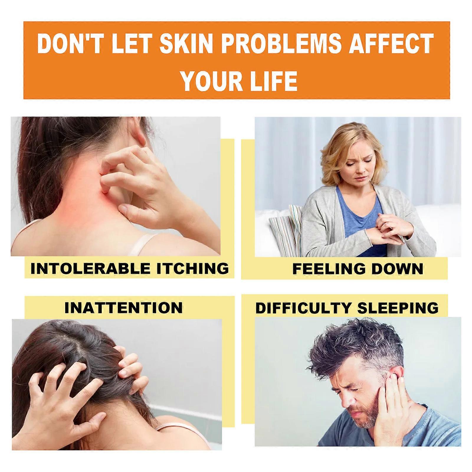 1/3Pcs 20g Skin Cream Anti-itching Ointment Skin Effective Rash Cream ...