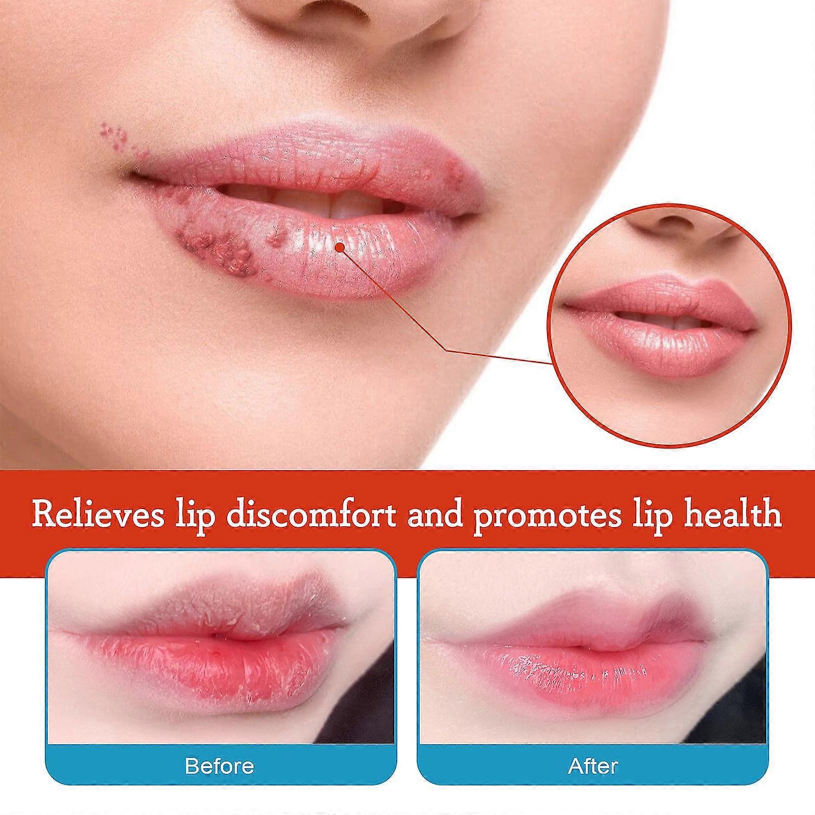 2pcs Dry Cracked Lips - Healing Lip Balm for Severely Chapped Lips ...