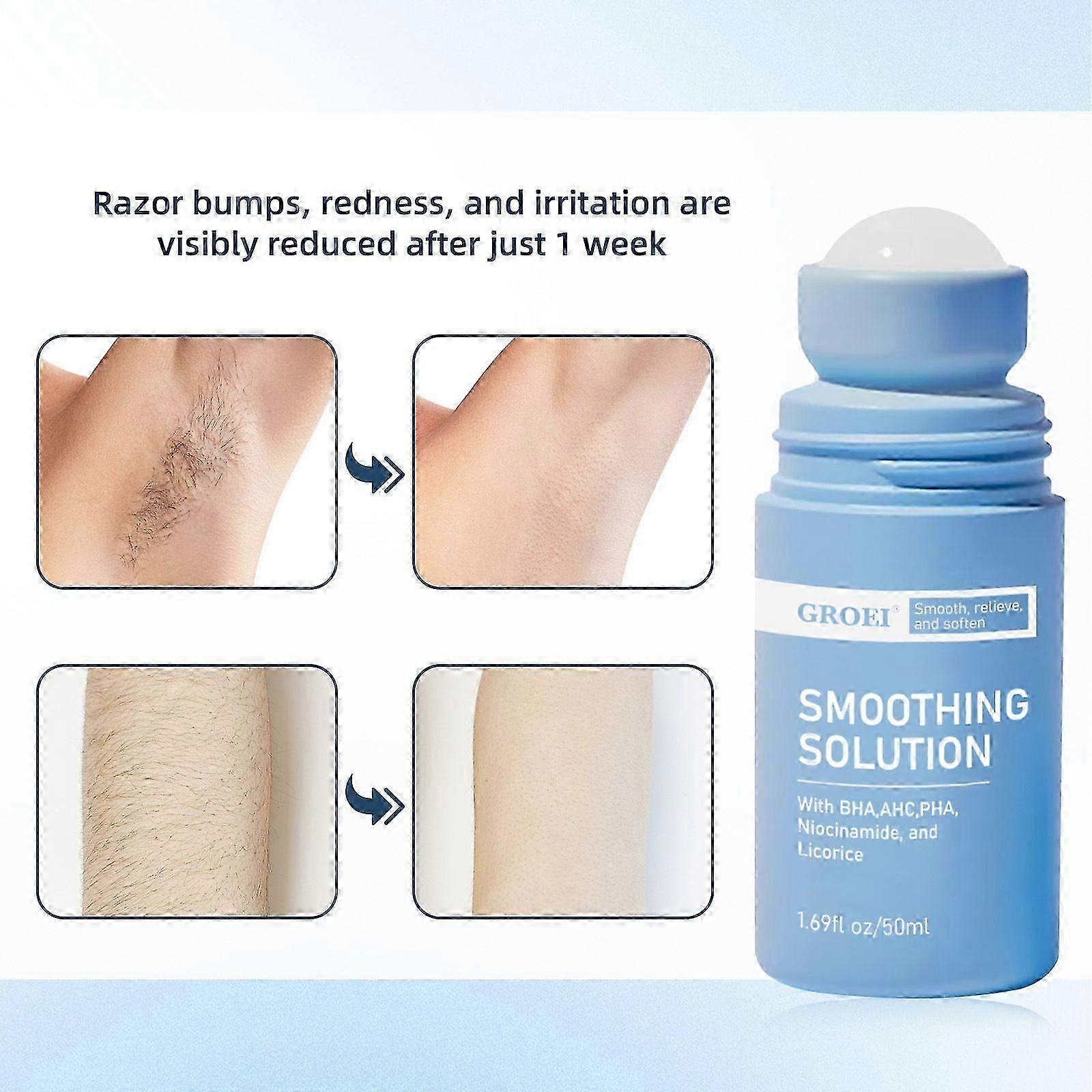 Ingrown Hair Treatment Roller, Razor Bump Stopper, Razor Bumps ...