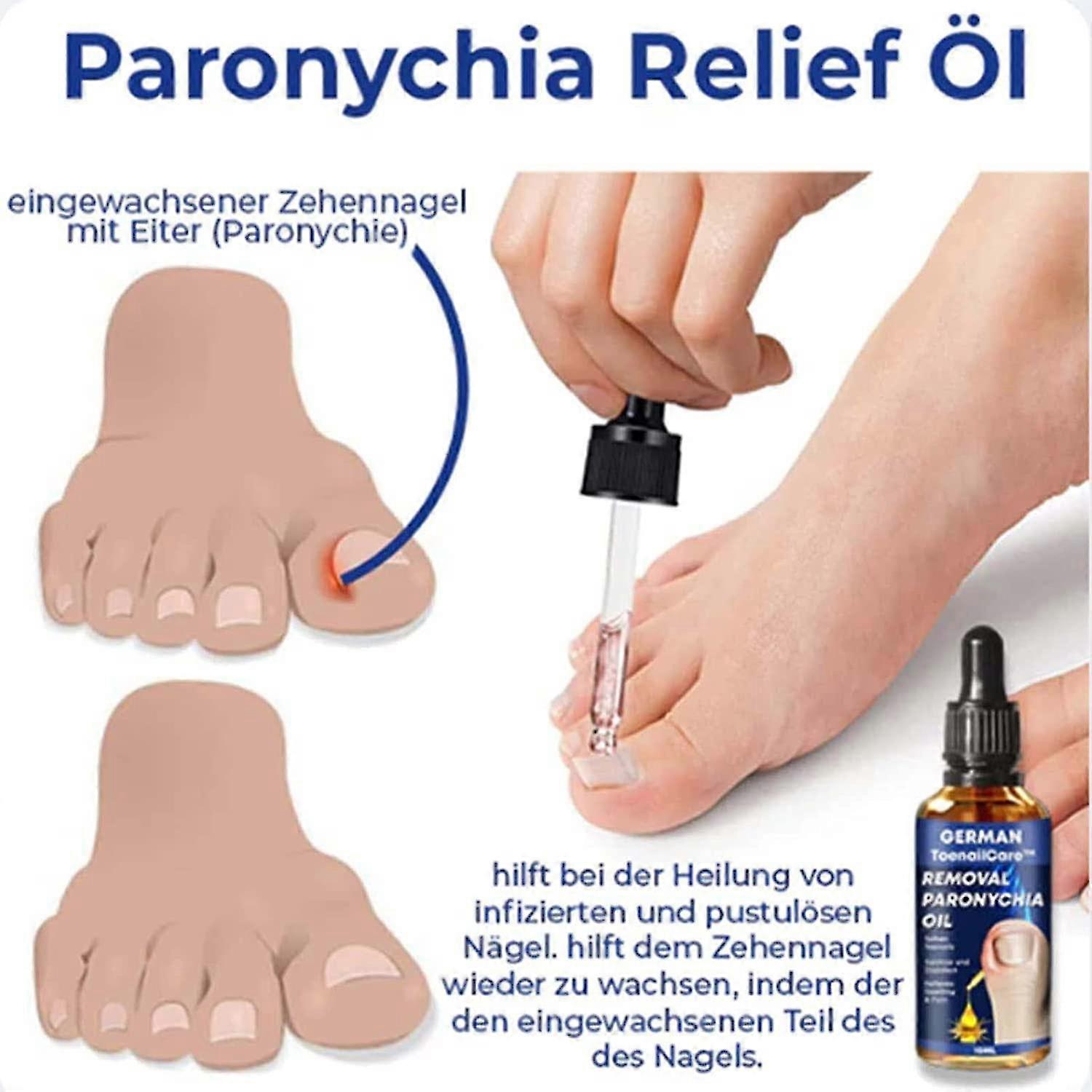 Toenailcare Removal Paronychia Oil, Ingrowing Toenail Treatment Oil ...