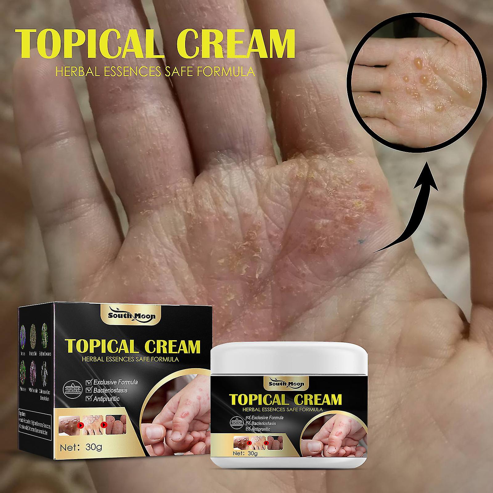 Anti-itch Cream For Sweaty Hands And Feet Dry Itchy Skin Itchy Relief ...