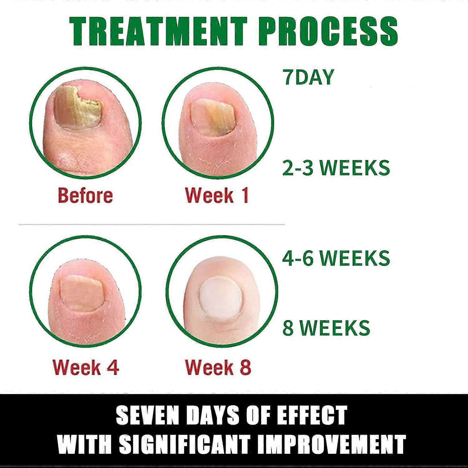 7days Nail Treatment, Ginger Nail Treatment, Multi-Purpose Nail Repair ...