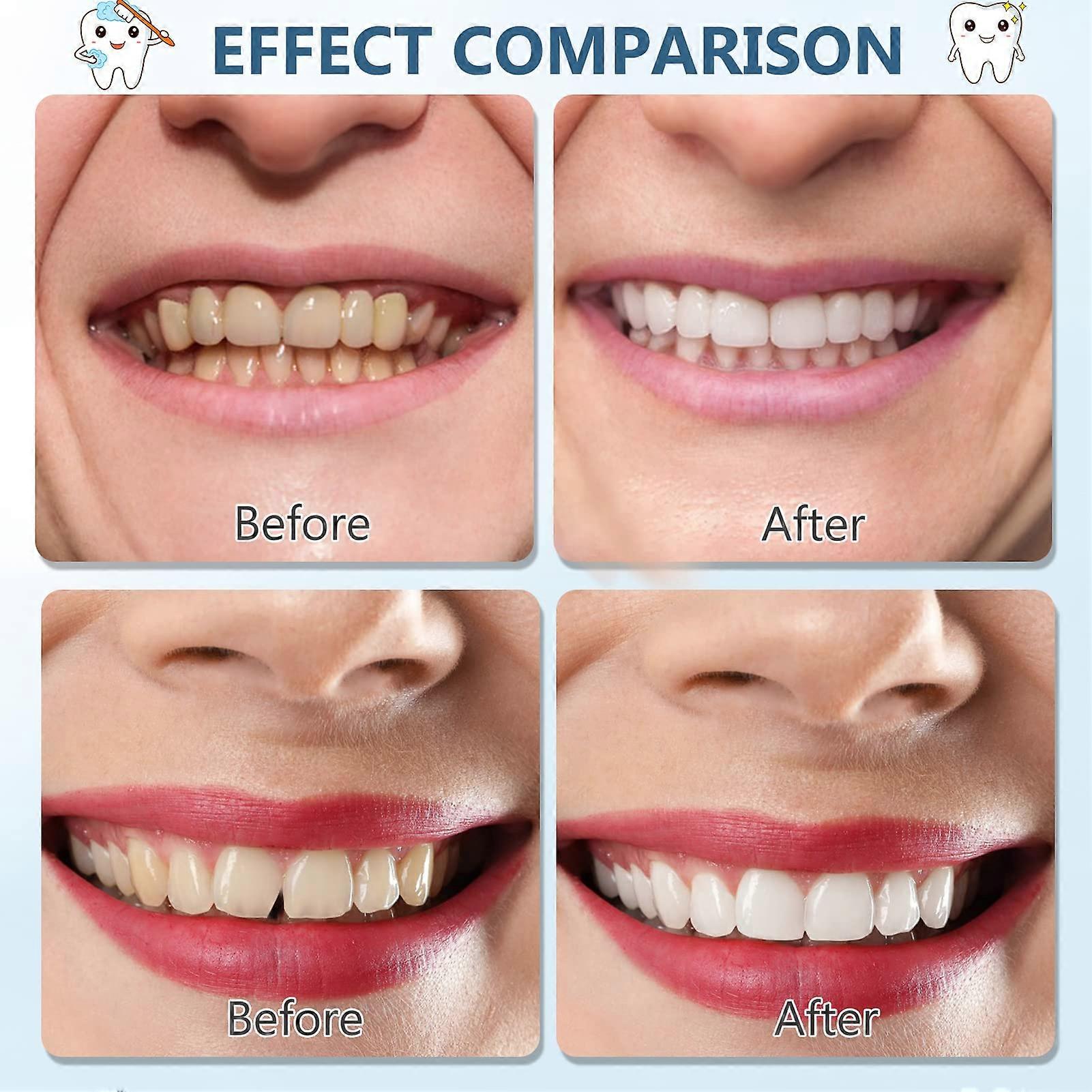 2 Pairs False Teeth Veneers, Veneers Teeth Cosmetic Tooth Cover Fake ...