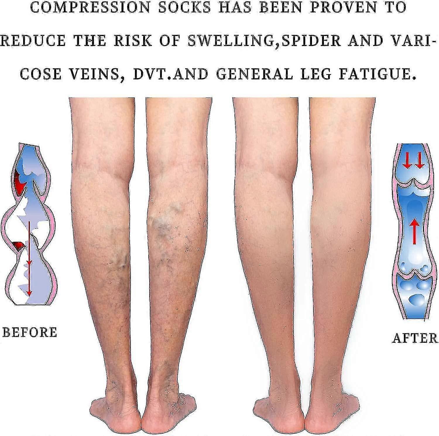 Compression Stockings For Women & Men, 20-30mmhg Thigh High Compression ...