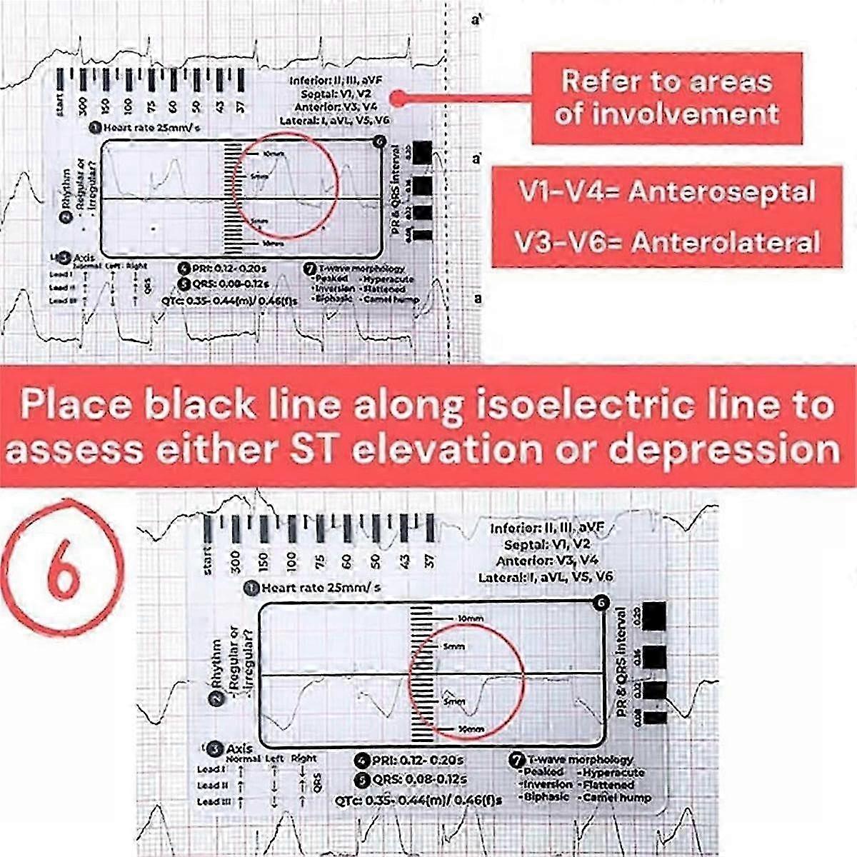 2pcs ECG 7 Step Ruler,ECG 7 Step Ruler for ECG/EKG Interpretation,ECG Reference Guide Ruler,EKG ...