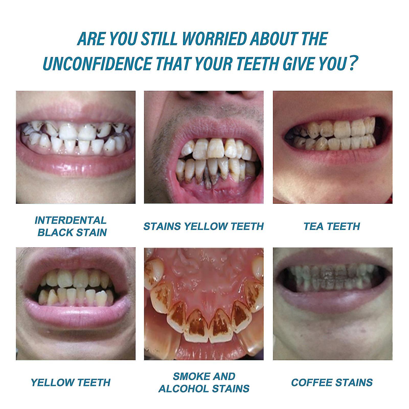 Eelhoe Tand Whitening Vloeibare Tand Vloeibare Tand Zwarte Tand Rook ...