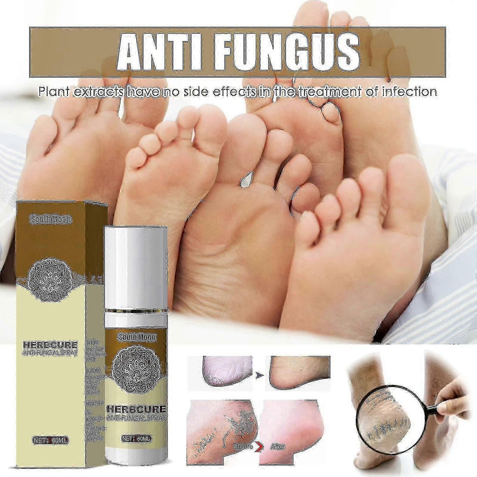 Fungal Combat Feet Spray Foot Sterilize Spray Herbal Anti-fungal ...