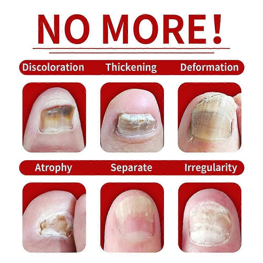 Nagelschimmel Behandelingen Serum Voetverzorging Serum Teen Nagels ...