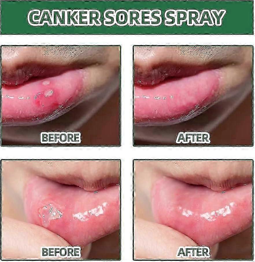 2pcs Ulcer Breath Sprays,oral Ulcer Sprays,antiviral Mouth Spray,canker ...