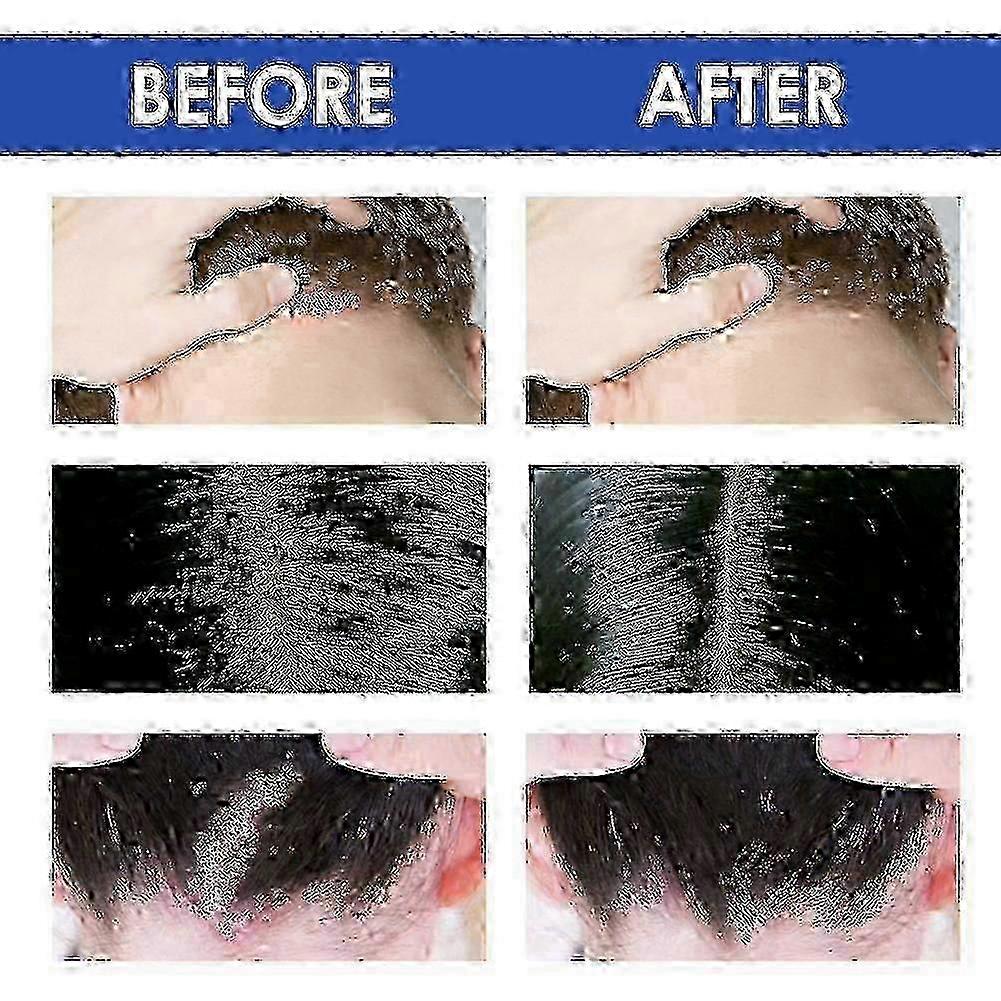Scalp Care Shampoo for Hair Psoriasis, Seborrheic Treatment, Dermatitis ...
