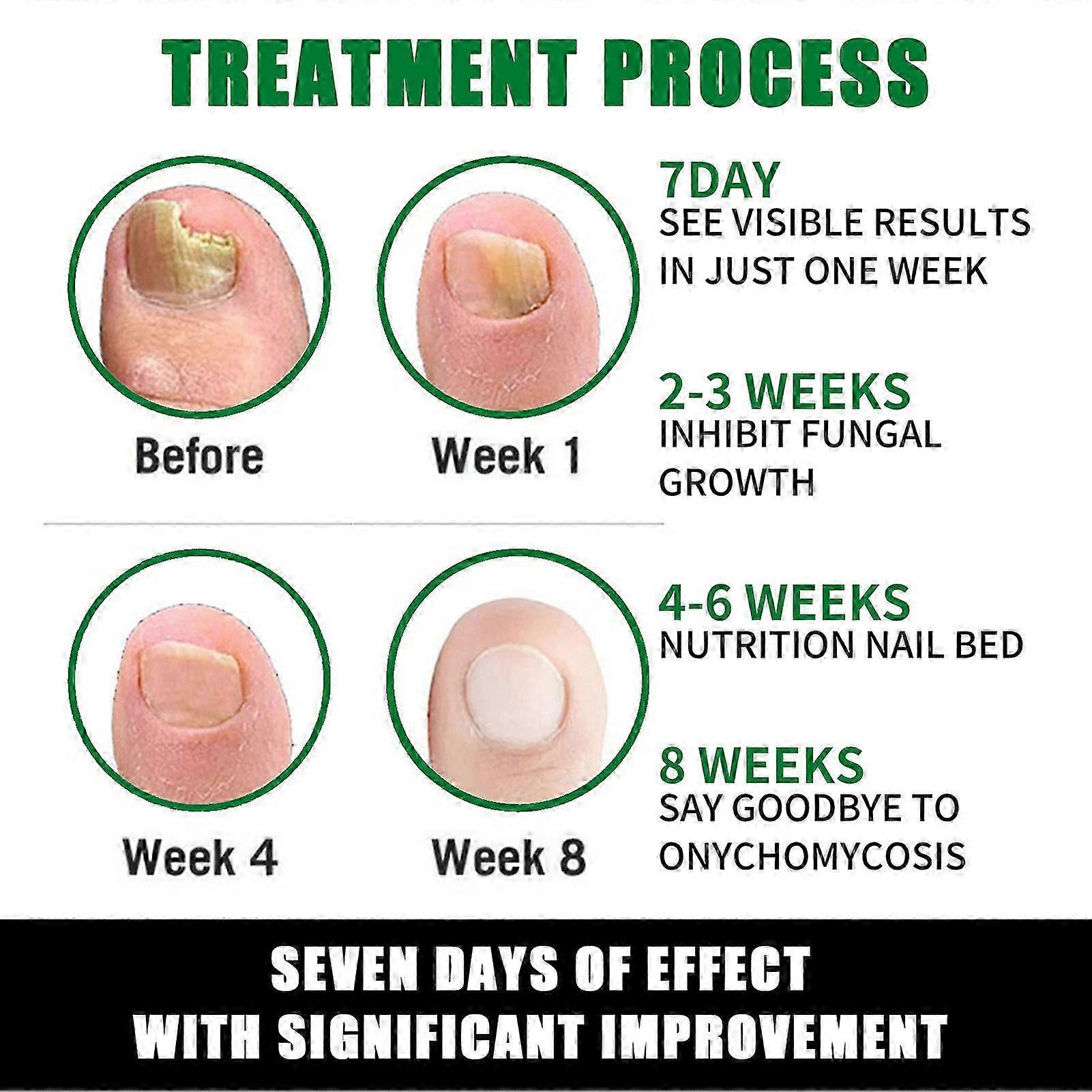 7 Days Nail Fungus Treatment, Jaysuing 7 Days Nail Fungus Treatment ...