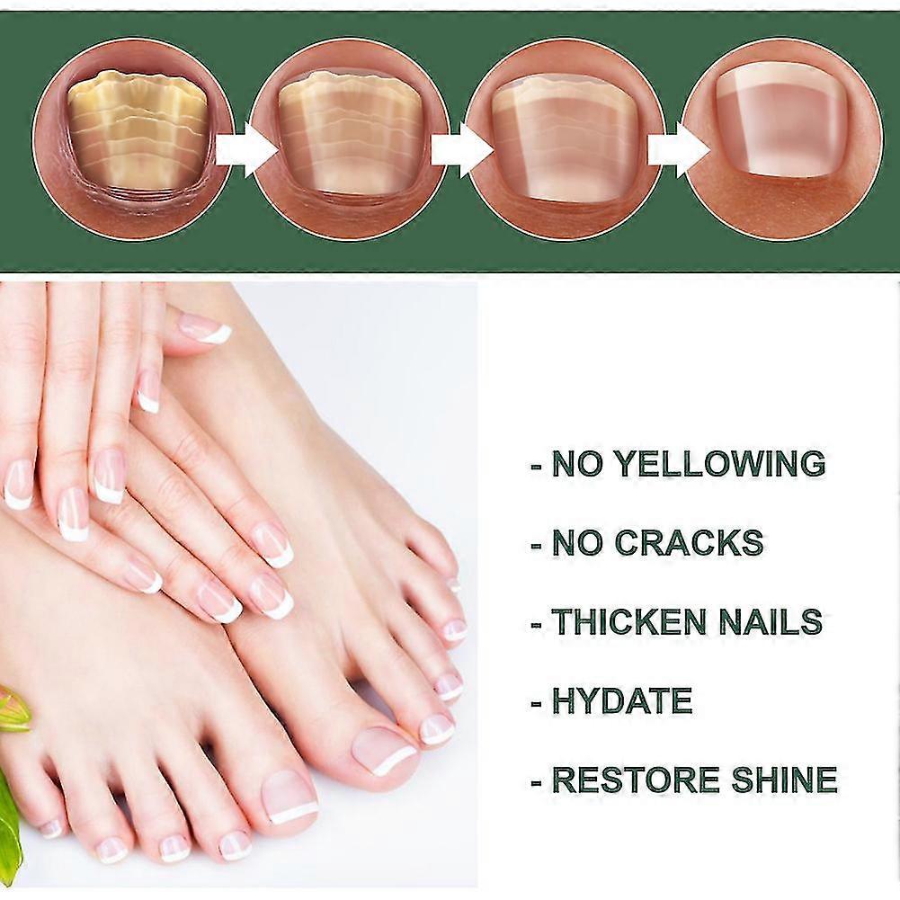 3pcs Nail Fungal Treatment Antibacterial Kills Toe & Finger Nail Fungus ...