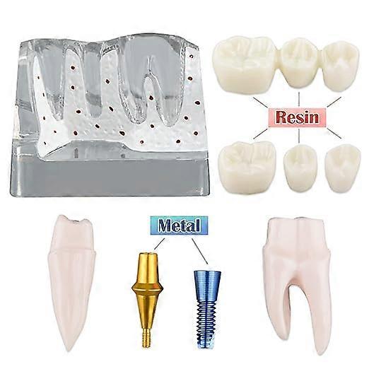 Dental Implant Model for Patient Education, 4 Times Dental Implant ...