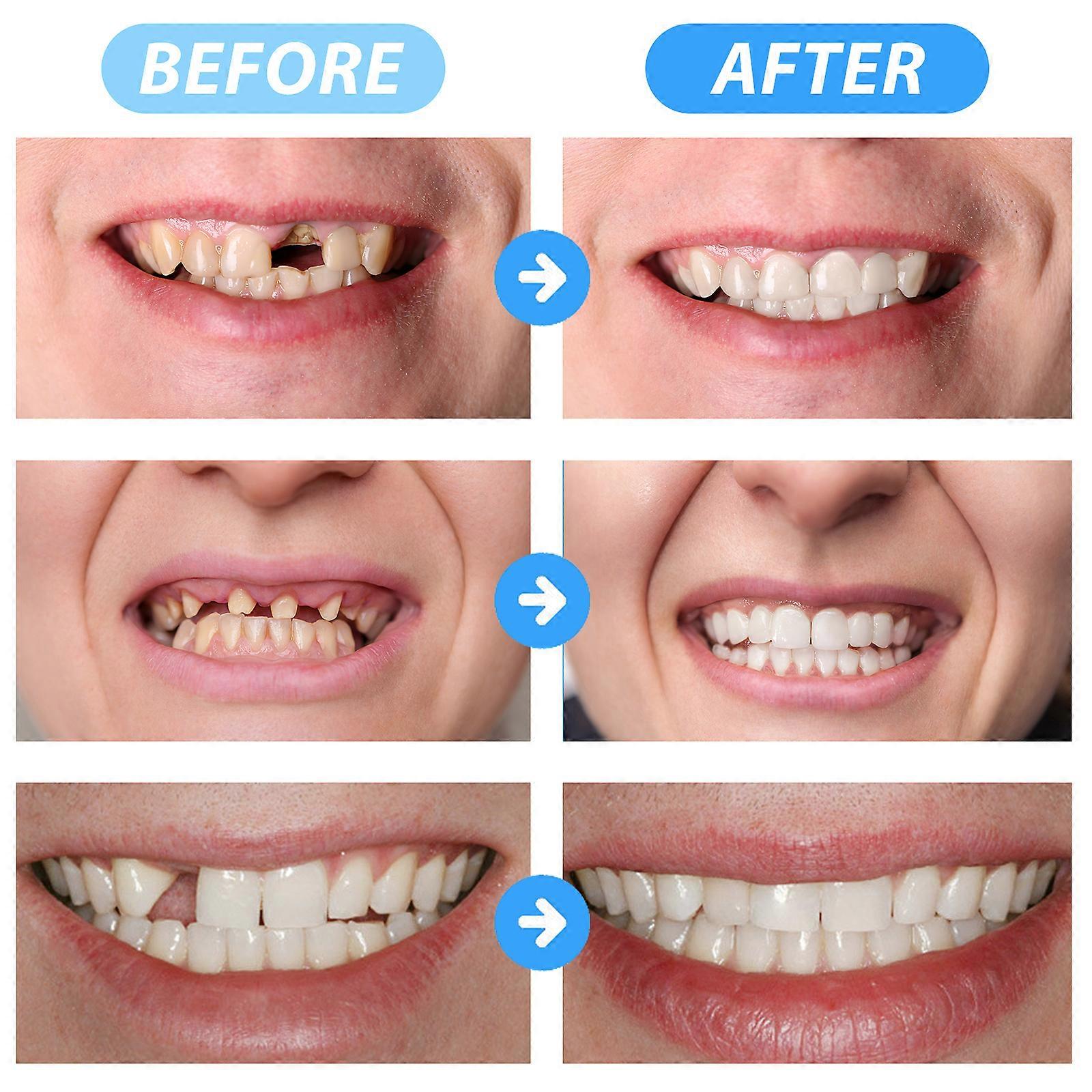 Tooth Repair Temporary Tool for Temporary Restoration of Missing Broken ...