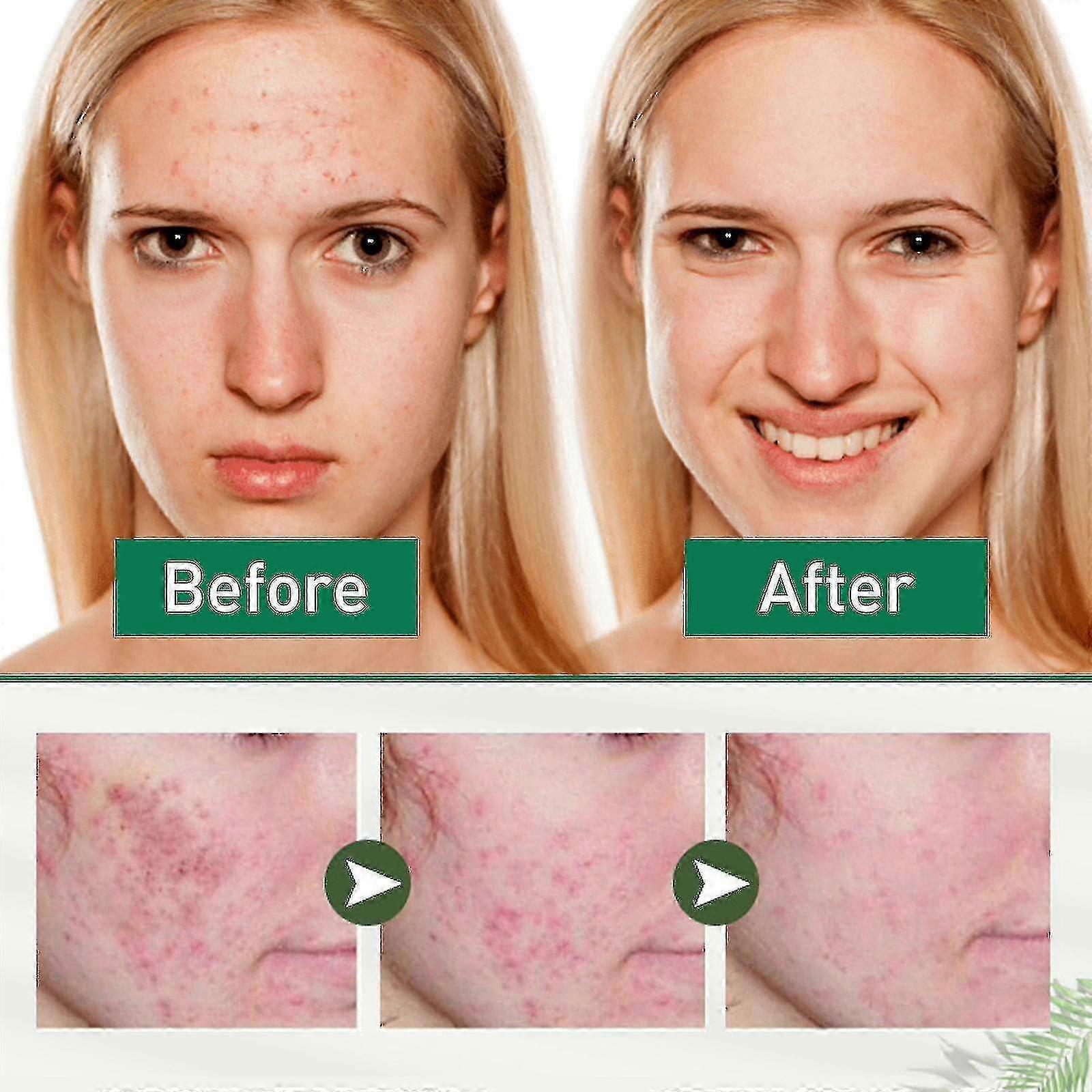 Jaysuing Tea Tree Oil Acne Essence Smallpox Diluting Facial Sensitive ...