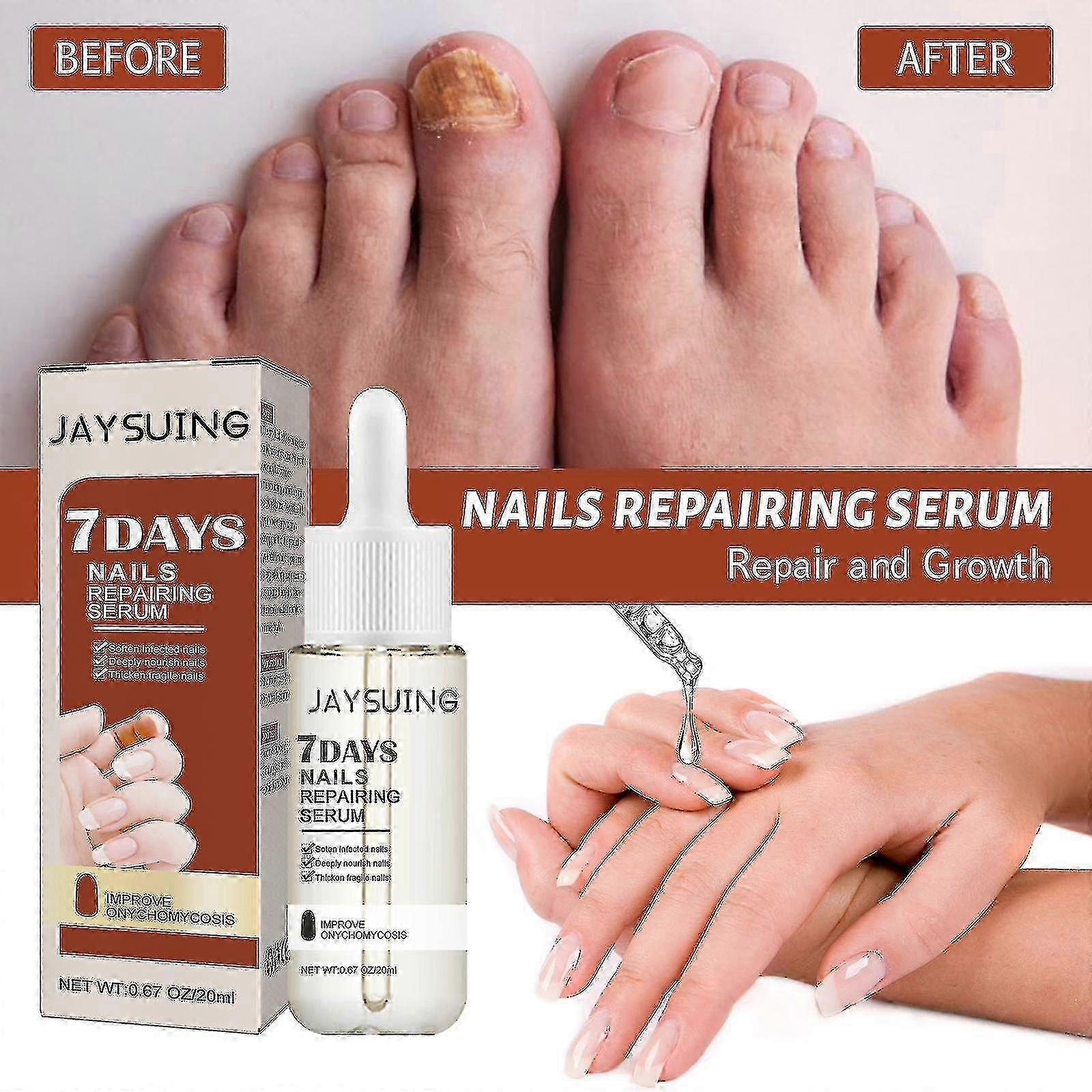 Jaysuing 7 Days Nail Repair Serum Nail Growth Strengthening Serum ...