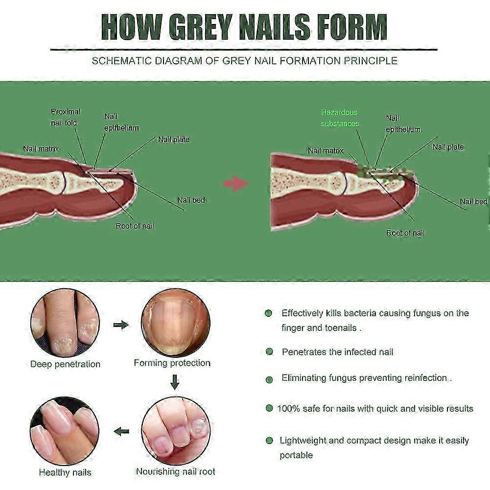 Nail Fungus Treatment Laser Pen Anti Fungus Infection Fungal Remove ...