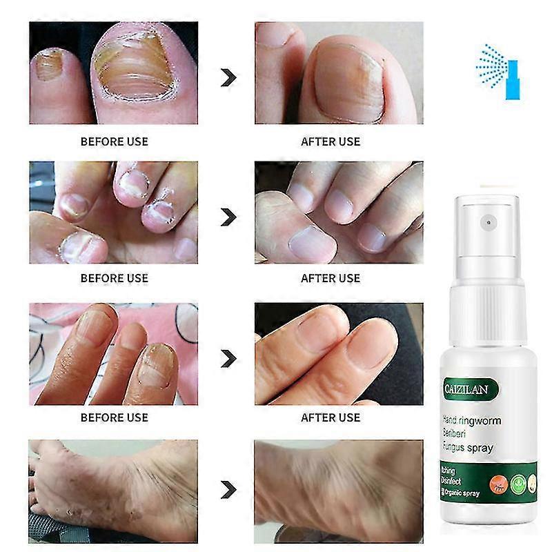 Hand And Foot Skin Spray Hand And Foot Spray Suitable For Dry, Cracked ...