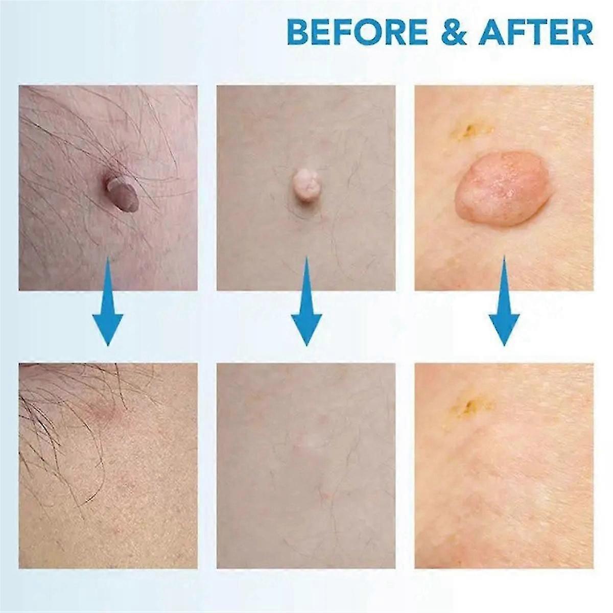 Skin Tag Removal Kit Painless Skin Tag Removal Pen Easy Skin Tag ...