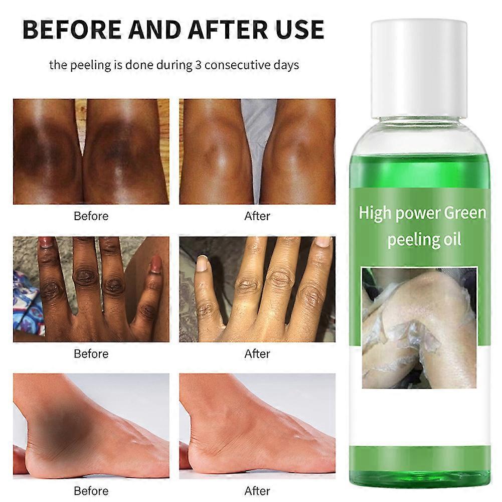 Extra Strong Peeling Exfoliating Green Skin Oil, Powerful Exfoliating ...
