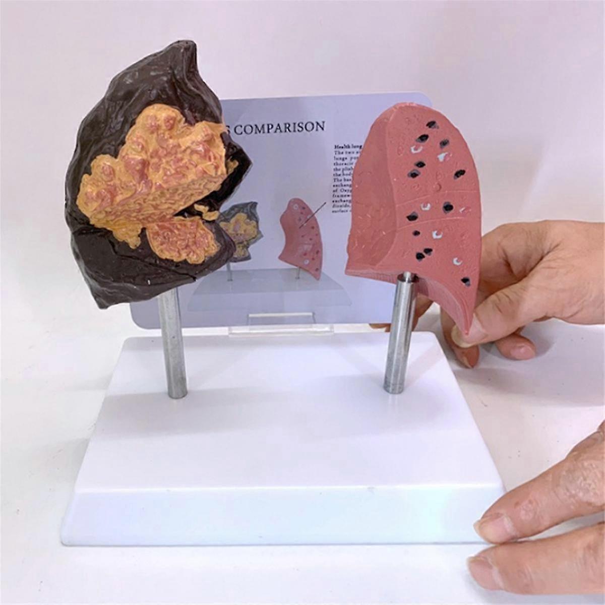 Smoker'S Lung Model Healthy Lung Model Lung Anatomy Model with ...