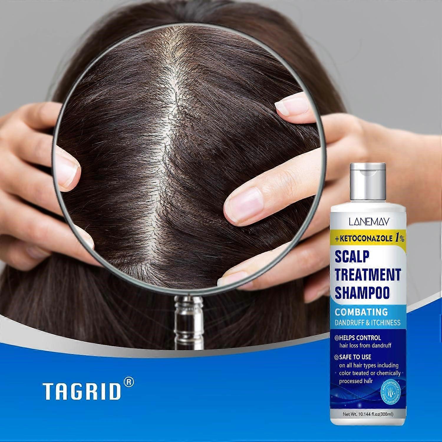 Ketoconazole Scalp Treatment Shampoo - Dandruff Treatment - Itchy Scalp ...