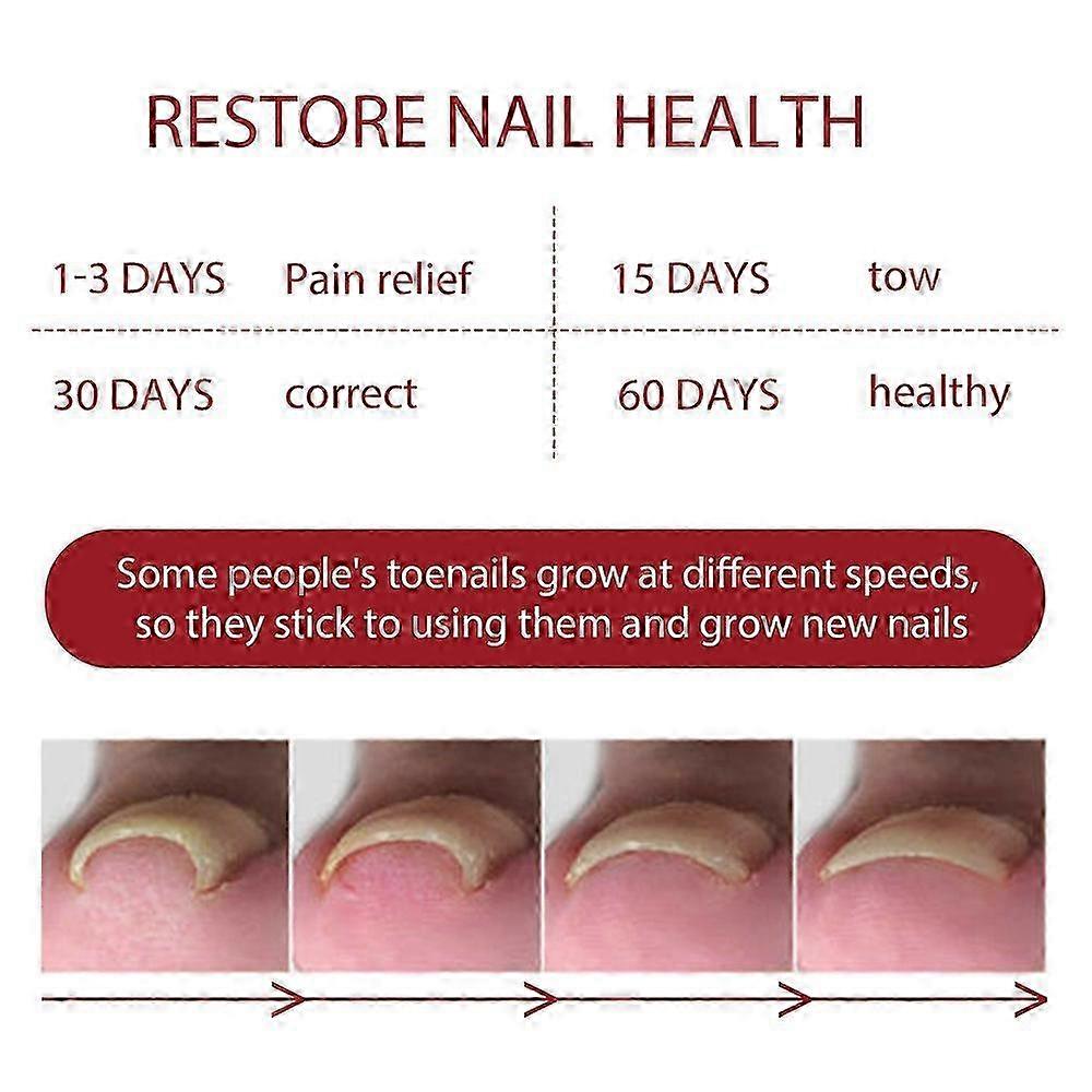 3pcs Ingrown Toenail Treatment, Toenailplus Anti Paronychia Relief Oil ...