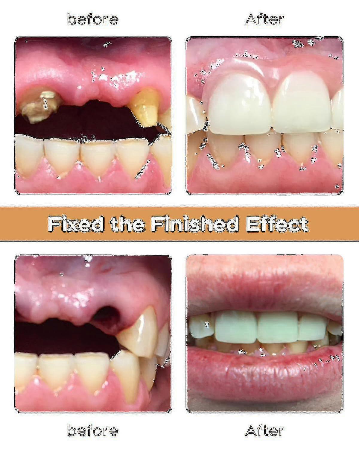 2024 Detta gör-det-själv-protessats, protes-DIY-kit är enkelt och ...