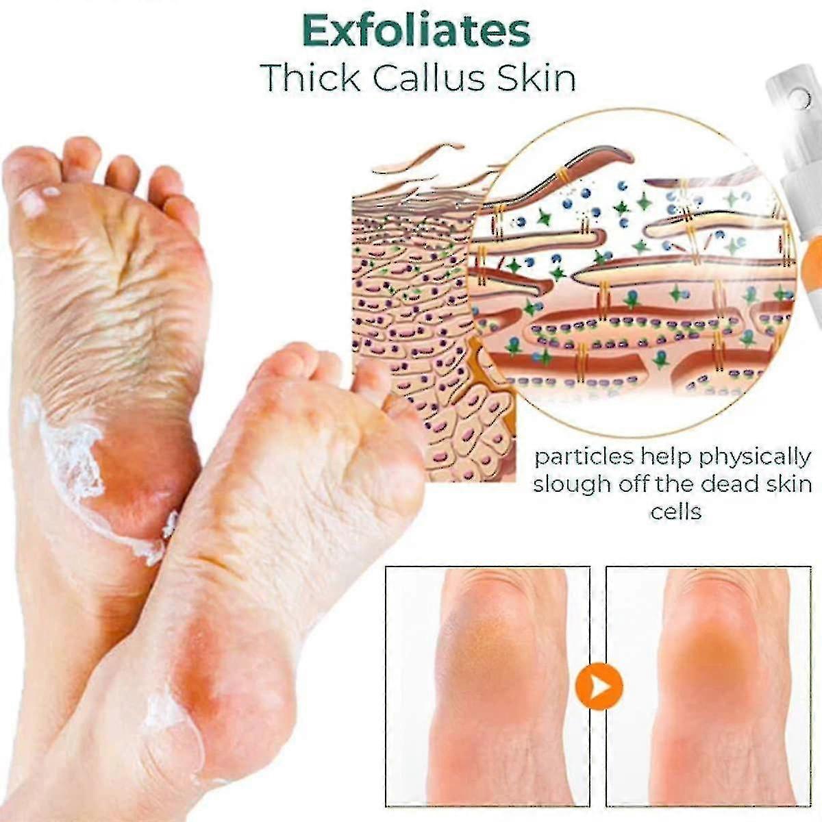 Foot Callus Removal - Foot Peeling Spray,pedicure Dead Skin Exfoliator ...