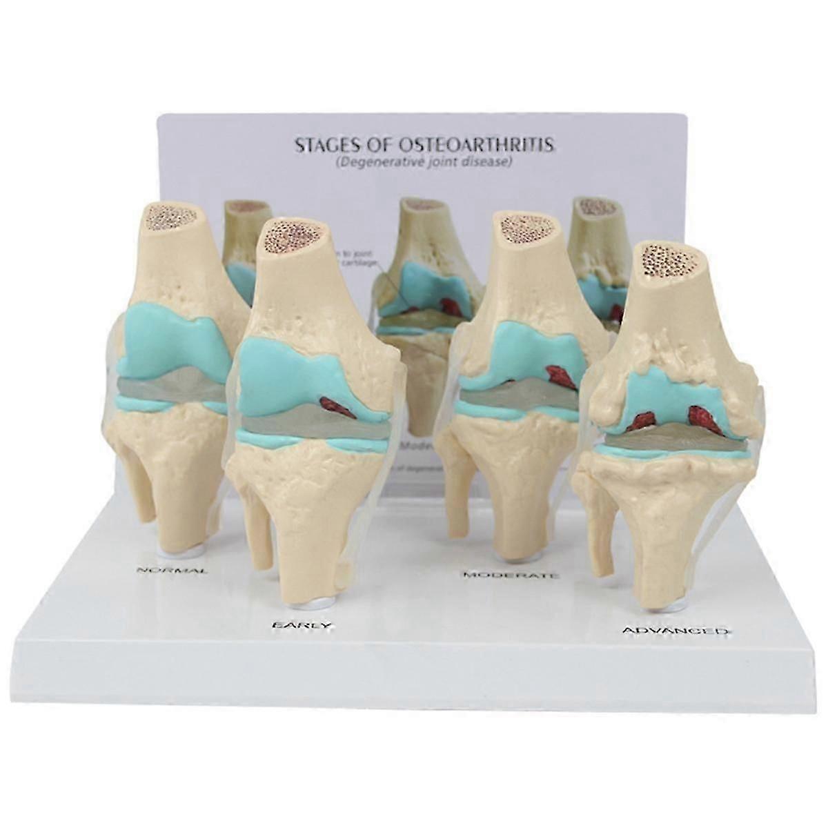 Knee Kit Osteoarthritis Anatomy Model with Educational Key Card 4 Stage ...