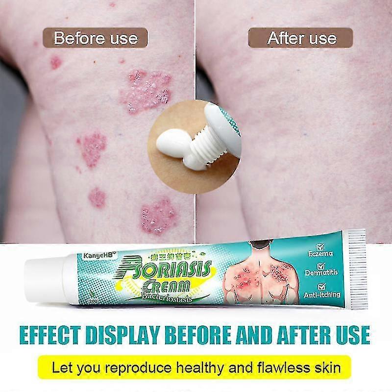 3pcs Ringworm Ointment Skin Topical Lichen Ointment Topical Ringworm ...