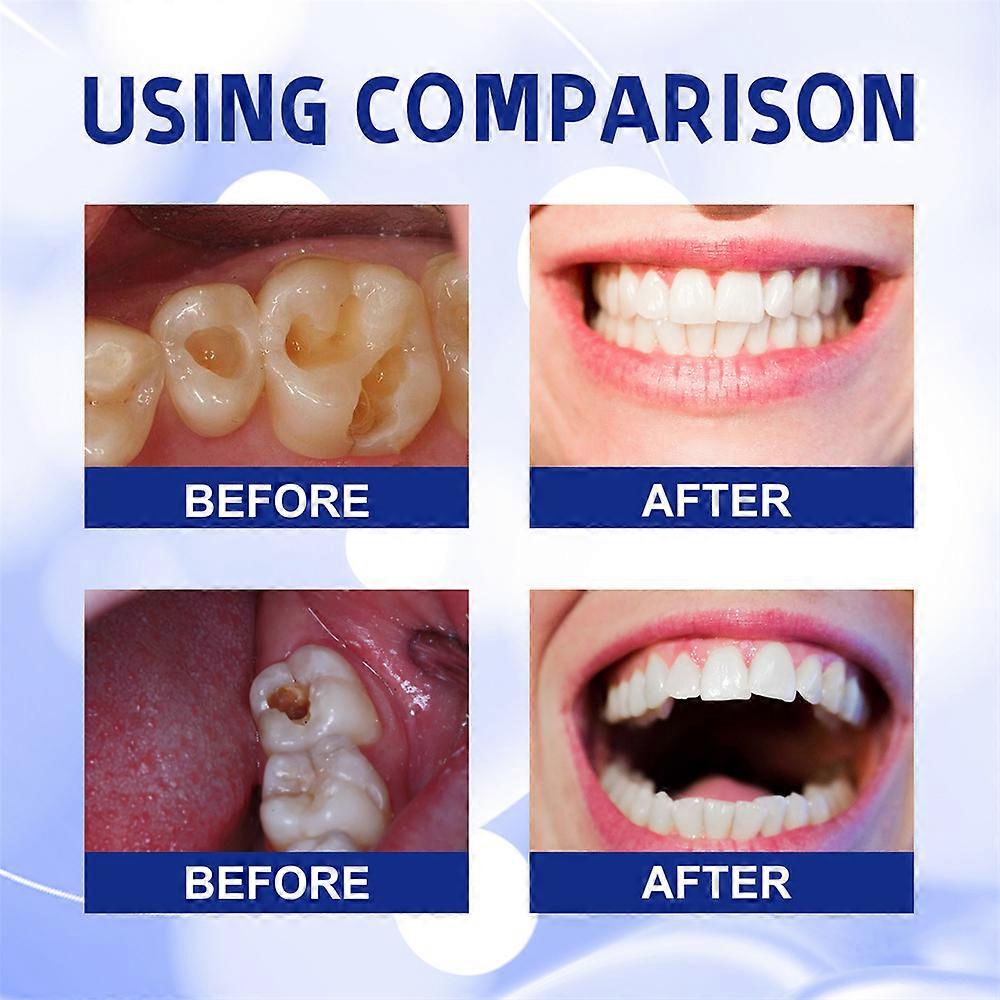 Toothpaste Dental Caries Repair Cream Prevent Tooth Decay Protect Teeth ...