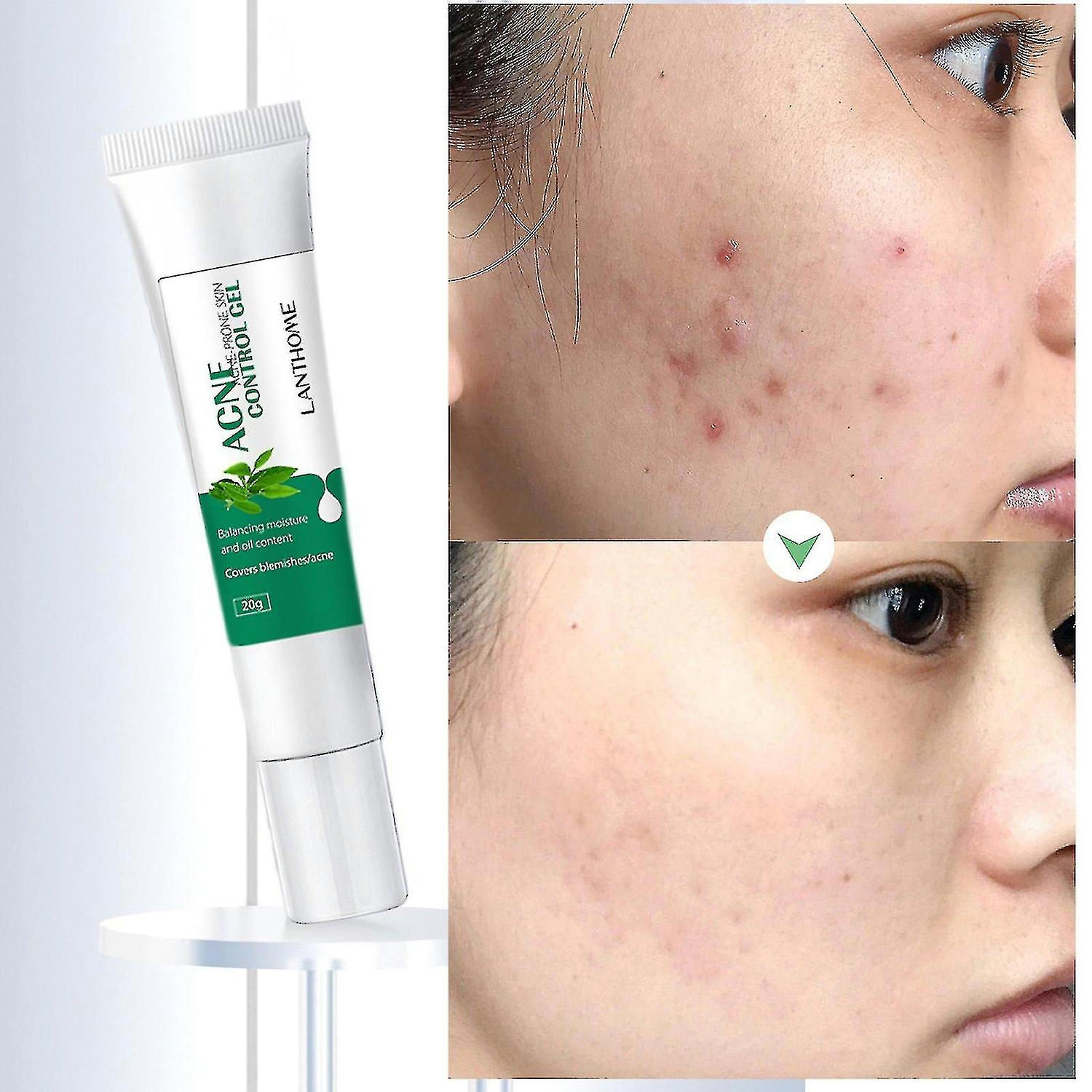 Tea Tree Gel Gel Cream Eliminate Pimple Pores For Face For Women Men ...