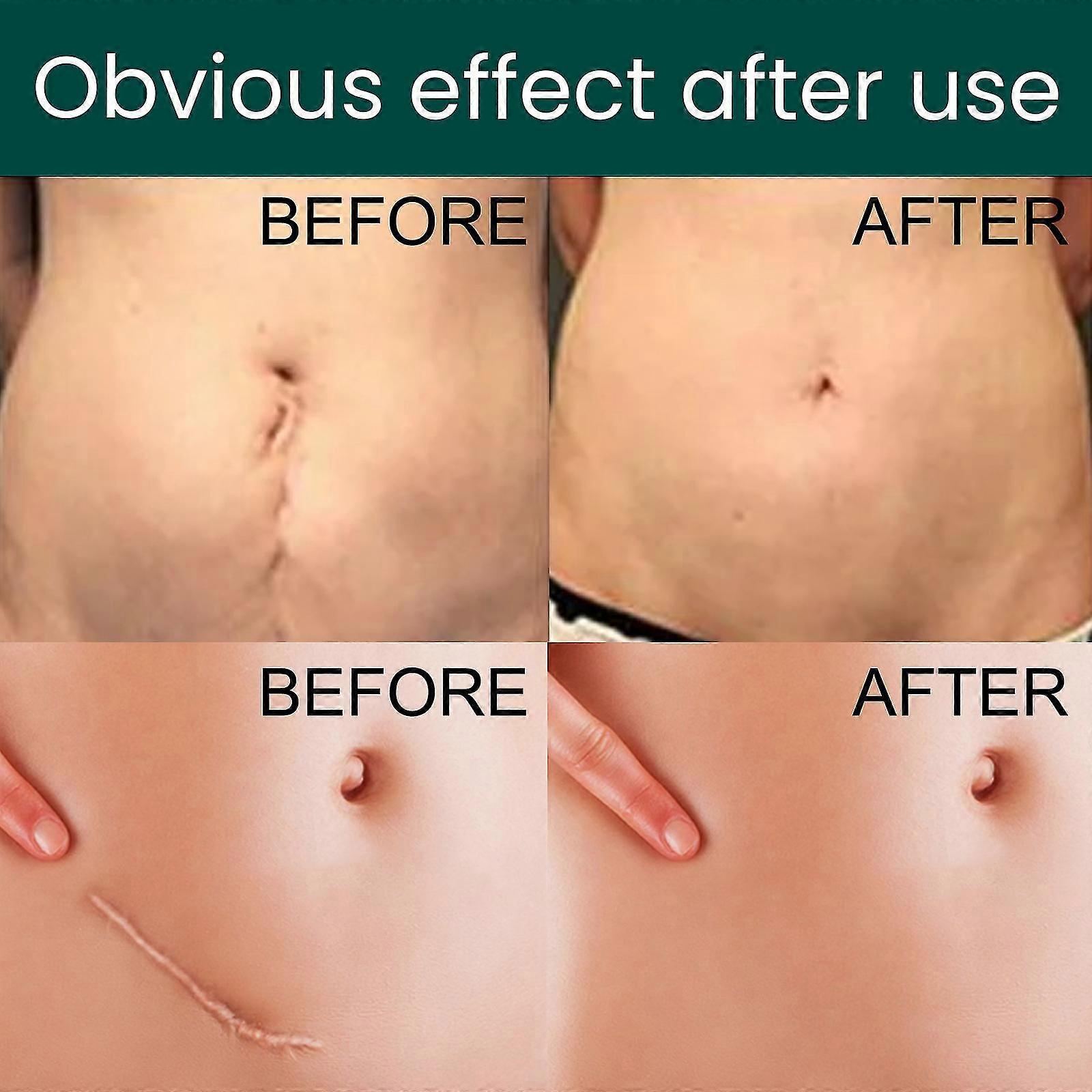 Silicone Scar Sheets - Extra Long Scar Sheets for C-Section, Tummy Tuck ...