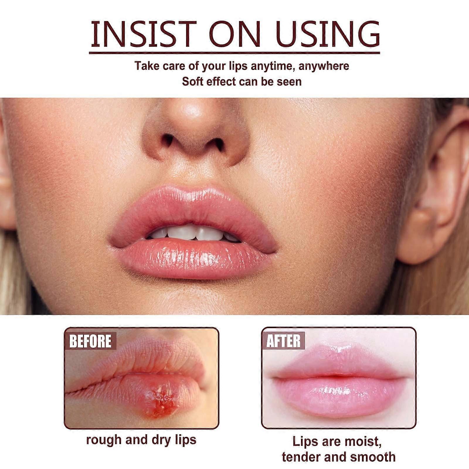 Lip Herpes And Cheilitis Cream, Effectively Nourishes Lips, And ...