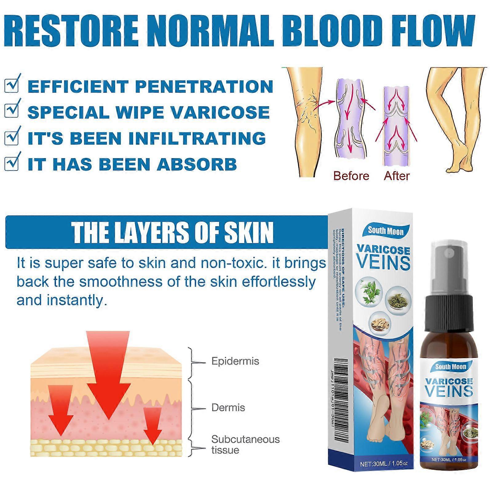 Varicose Vein Massage Spray for South Moon - Say Goodbye to Leg ...