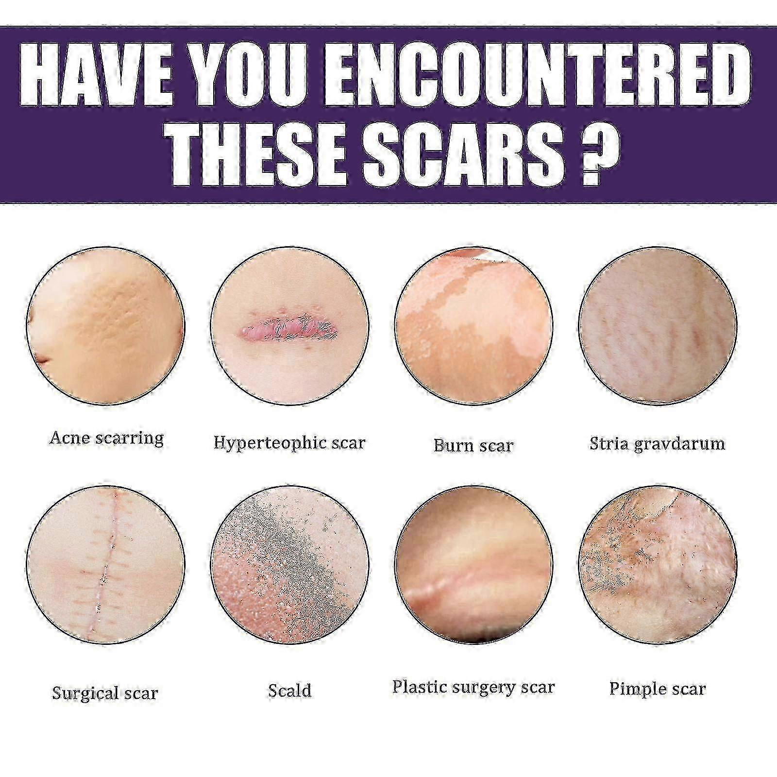 Silicone Scar Stickers Dilute Scars Caesarean Section Surgery Scar ...