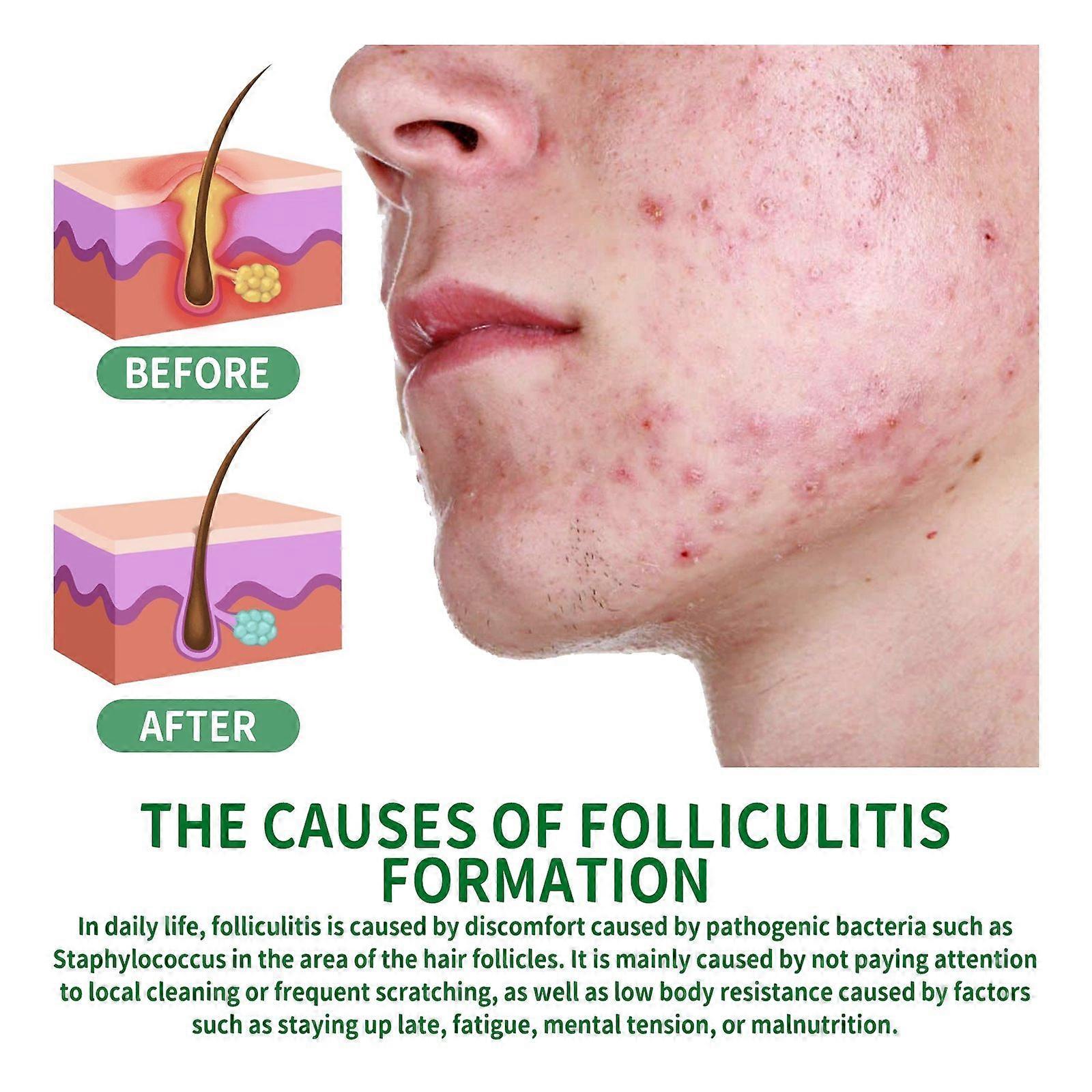 Skin Care Hair Follicle Cream Back And Face Acne Anti-Itch Hair ...