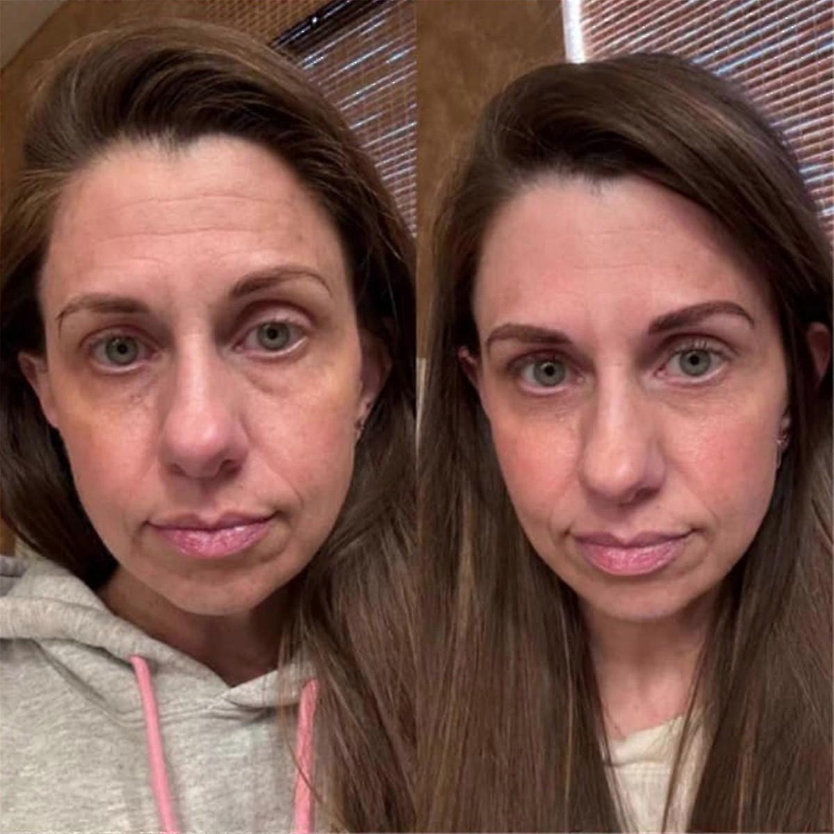 Patches for Wrinkles, Cesarean Section Patches 25-26 | Fruugo AU