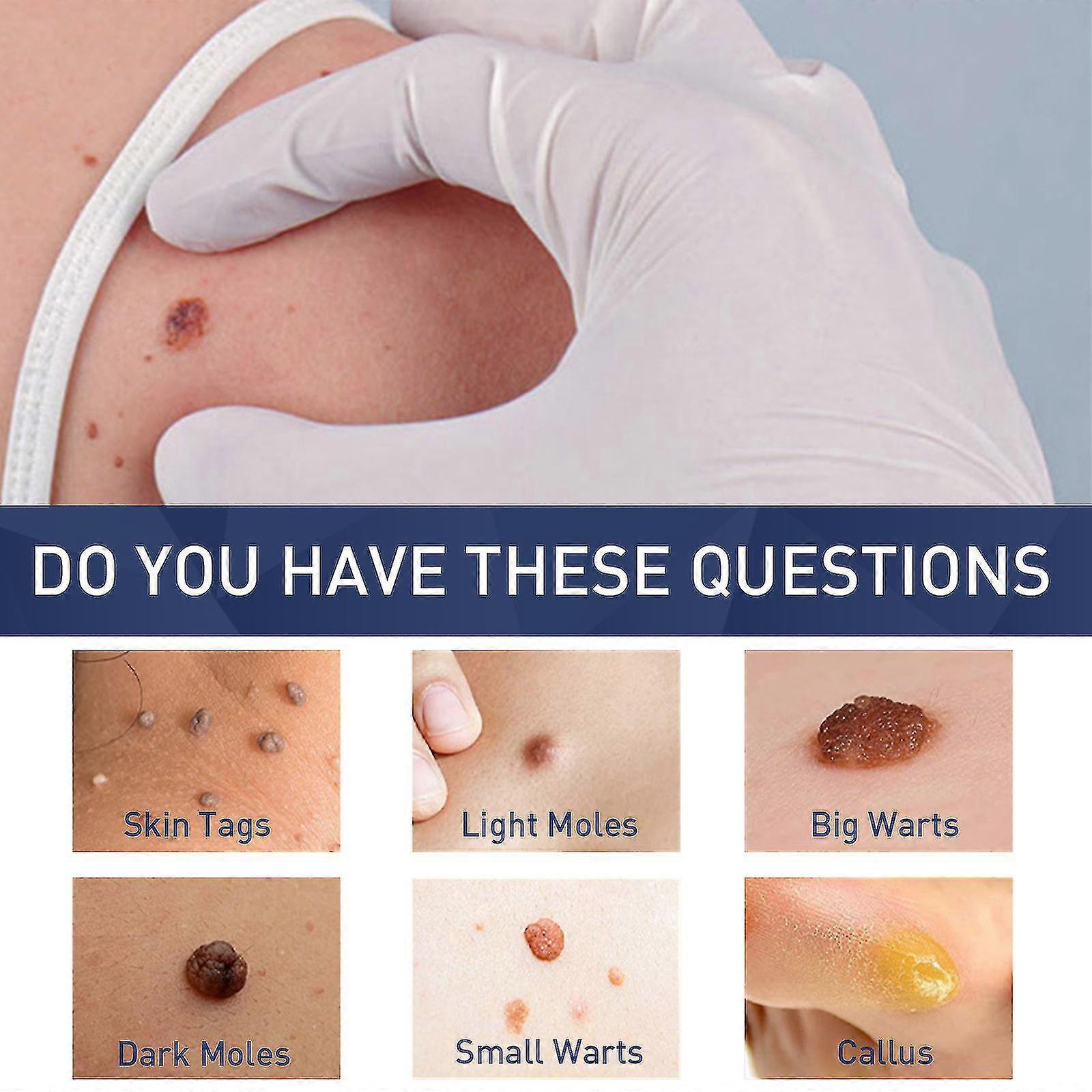 Jaysuing Gram Wart Agent Skin Especially Chicken Eye Meat Thorn Body ...