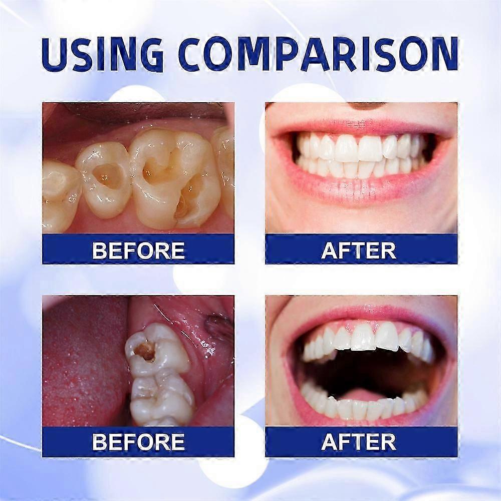 Anti Decay Toothpaste Dental Caries Repair Cream Prevent Decay Protect ...
