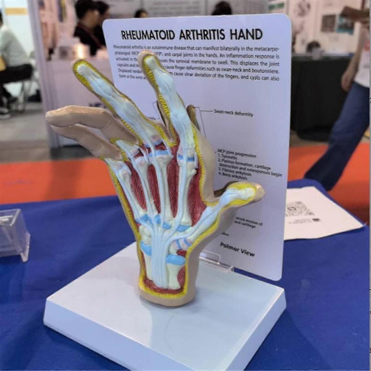 Osteoarthritis Hand Model, Model Of Hand Pathology, Human Anatomy And ...