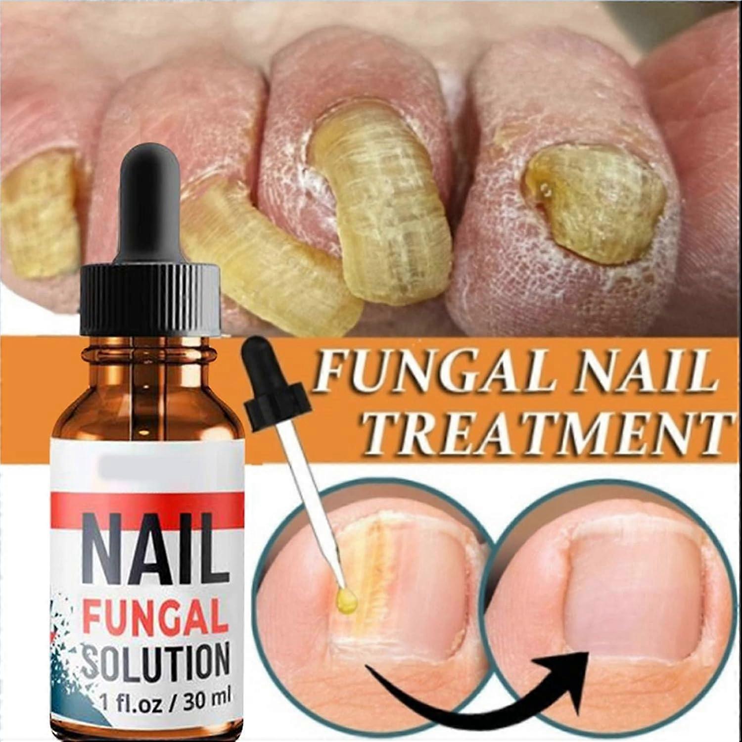 Nail Fungal Solution, Fungal Nail Treatment for Toenails Extra Strong ...